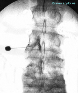 ARYDOL - Bloqueo radicular selectivo - Transforaminal