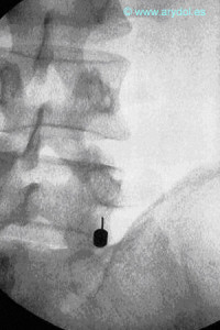 ARYDOL - Bloqueo radicular selectivo - Transforaminal