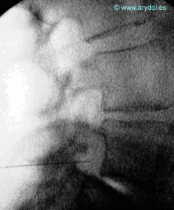 ARYDOL - Bloqueo radicular selectivo - Transforaminal