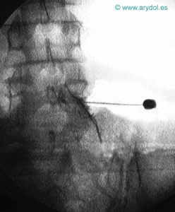 ARYDOL - Bloqueo radicular selectivo - Transforaminal