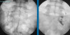 ARYDOL - Bloqueo radicular selectivo - Transforaminal