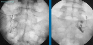 ARYDOL - Bloqueo radicular selectivo - Transforaminal