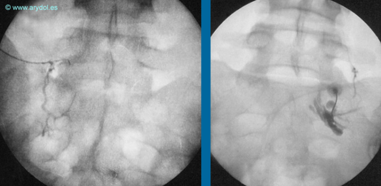 ARYDOL - Bloqueo radicular selectivo - Transforaminal