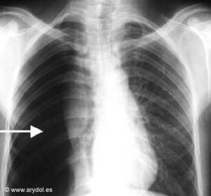 ARYDOL - Bloqueo nervio supraescapular