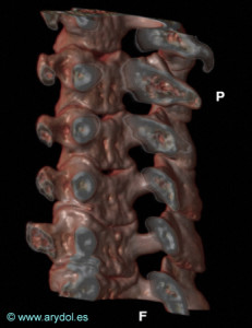 ARYDOL - Bloqueo radicular selectivo - Transforaminal
