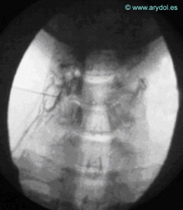 ARYDOL - Bloqueo radicular selectivo - Transforaminal