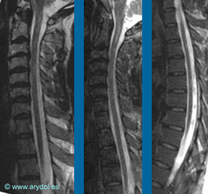 ARYDOL - Bloqueo radicular selectivo - Transforaminal