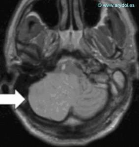 ARYDOL - Bloqueo radicular selectivo - Transforaminal